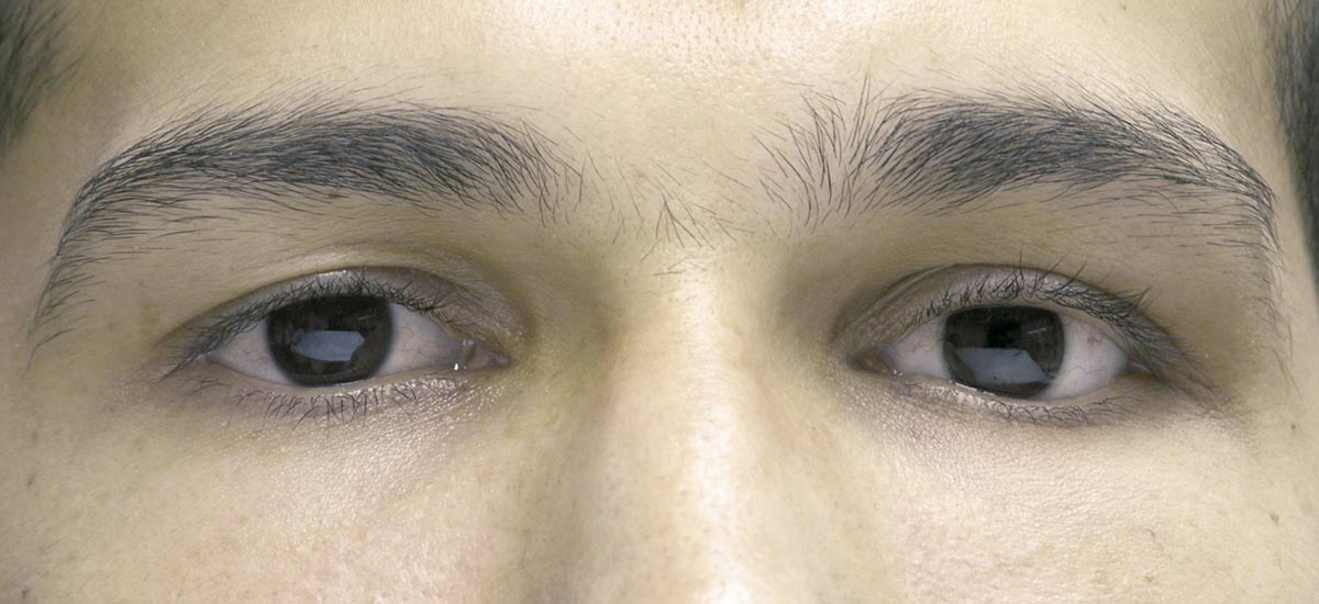 Prótesis - Protescol Prótesis Ocular